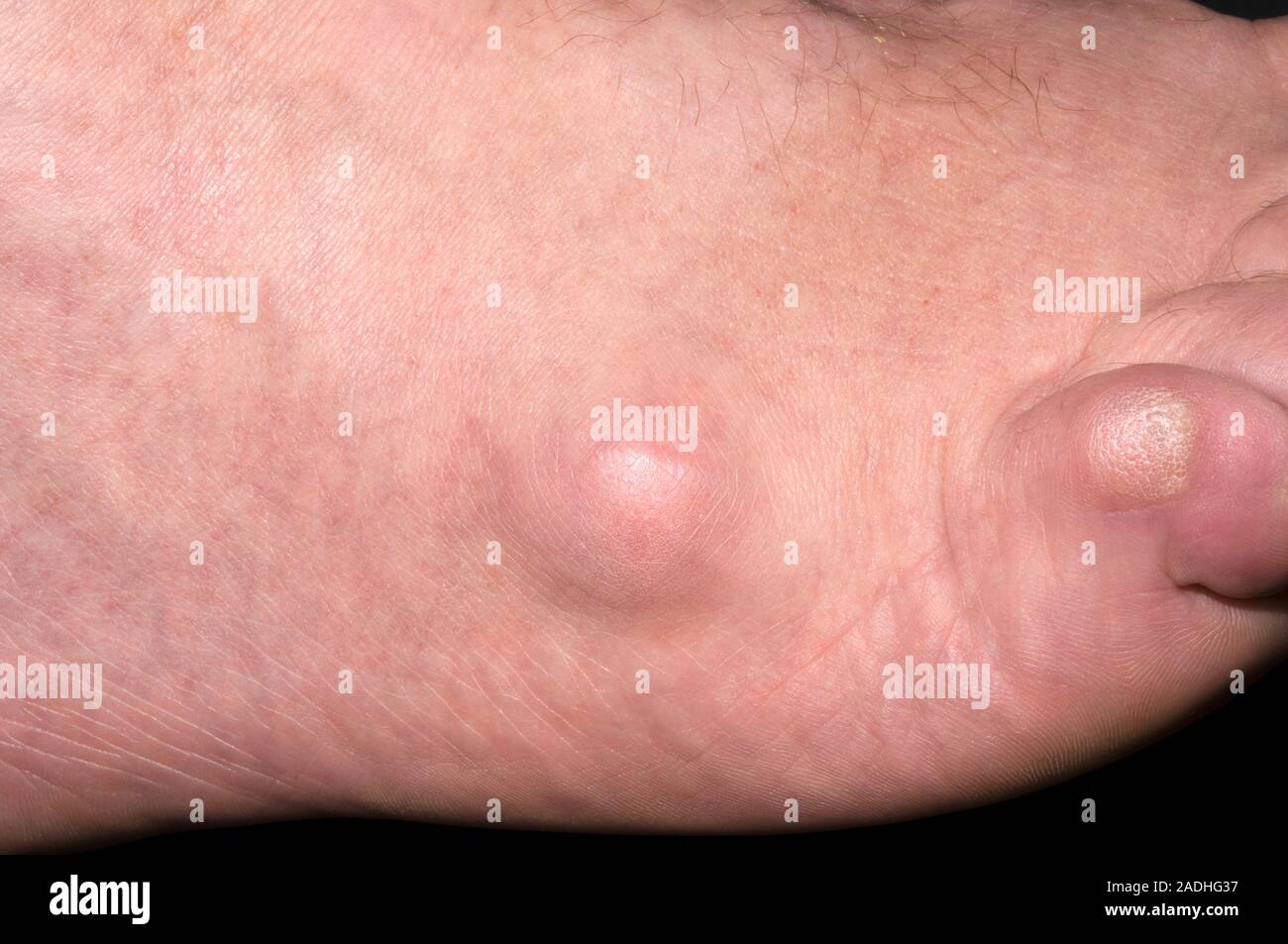 Ganglion (lump at lower centre) on a 55-year-old man's foot. This is a ...