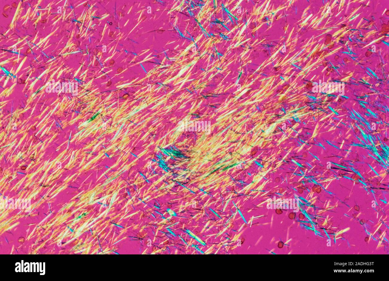 Gout crystals. Polarised light micrograph of uric acid crystals in the ...