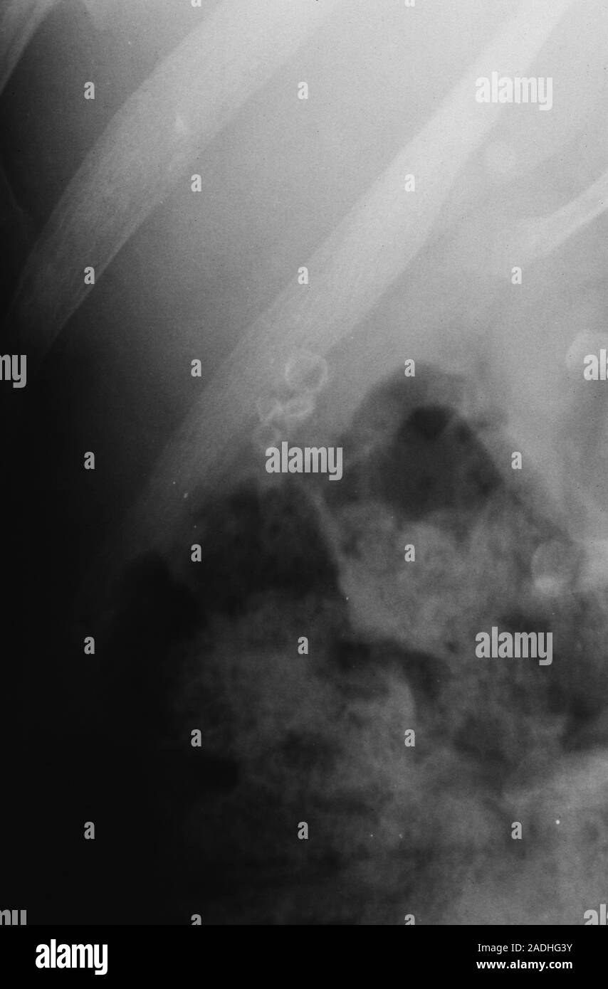 Gallstones. X-ray of gallstones (pale circles, upper centre) in a ...