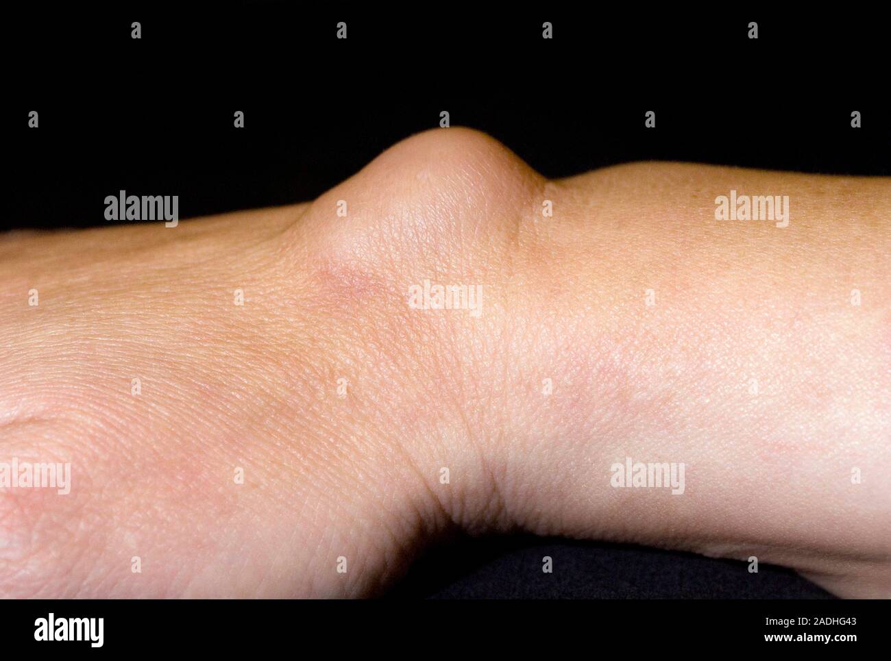 Ganglion (lump at upper centre) on a woman's wrist. This is a type of ...