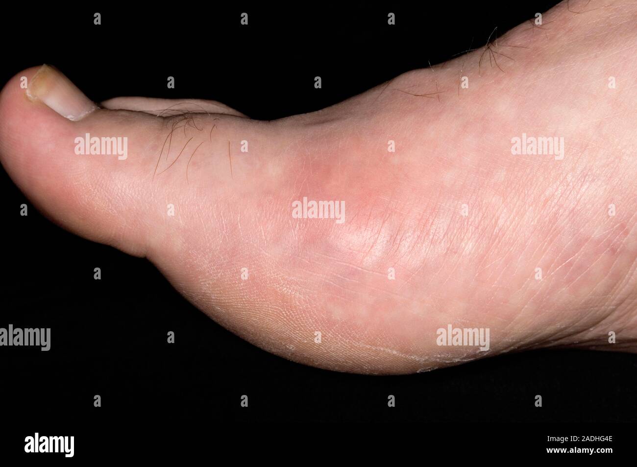 Gout of the big toe joint of a 51-year-old man. Gout is a condition in ...