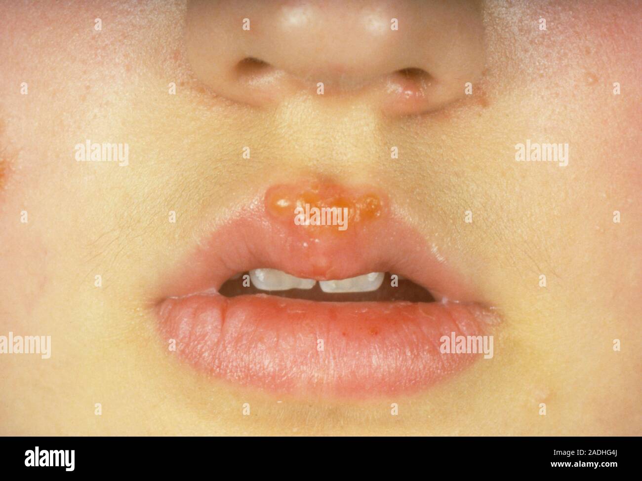 Young girl with Herpes simplex, or cold sore, on the edge of the upper ...