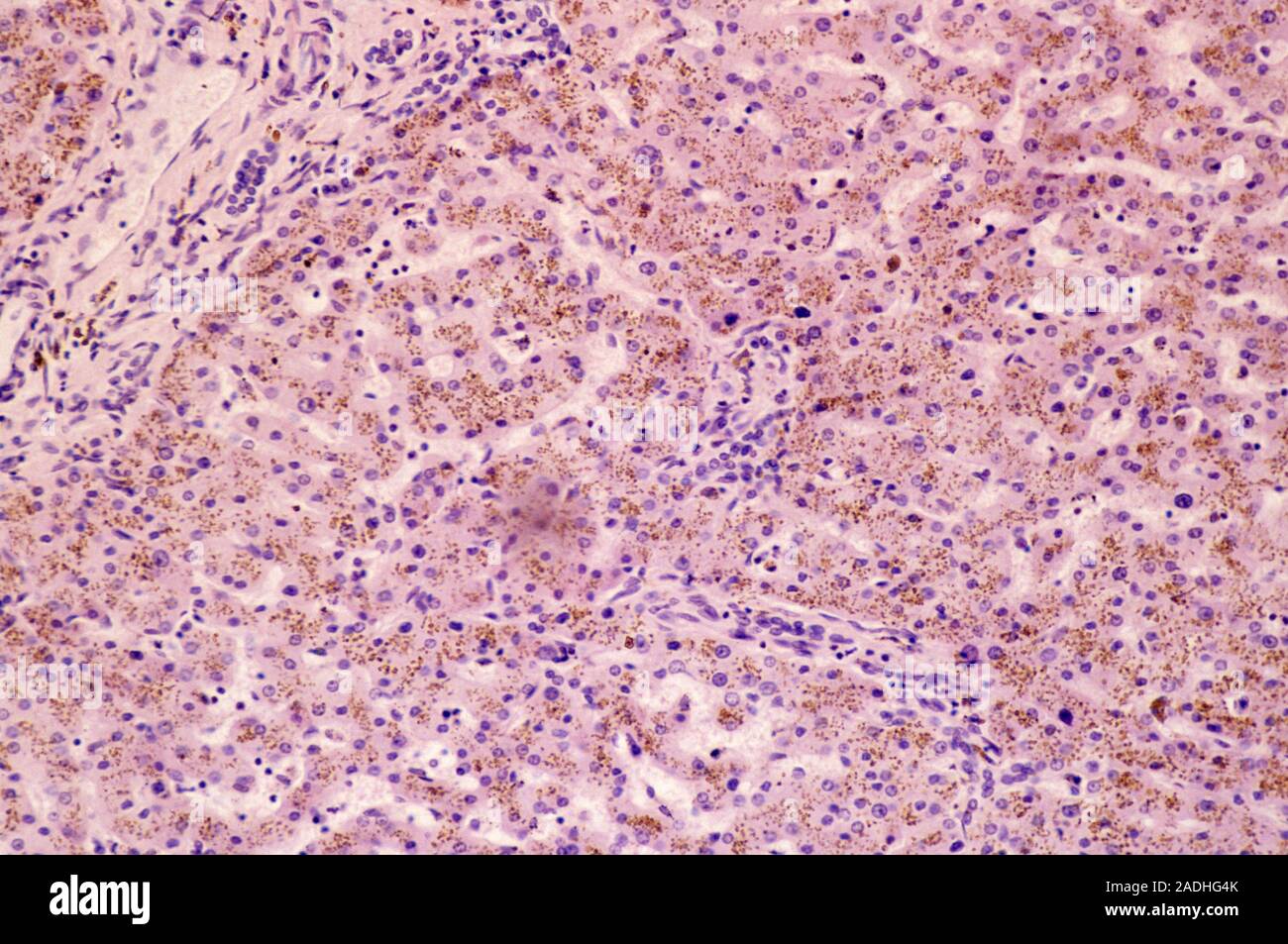 Light micrograph of a section of the human liver affected by ...