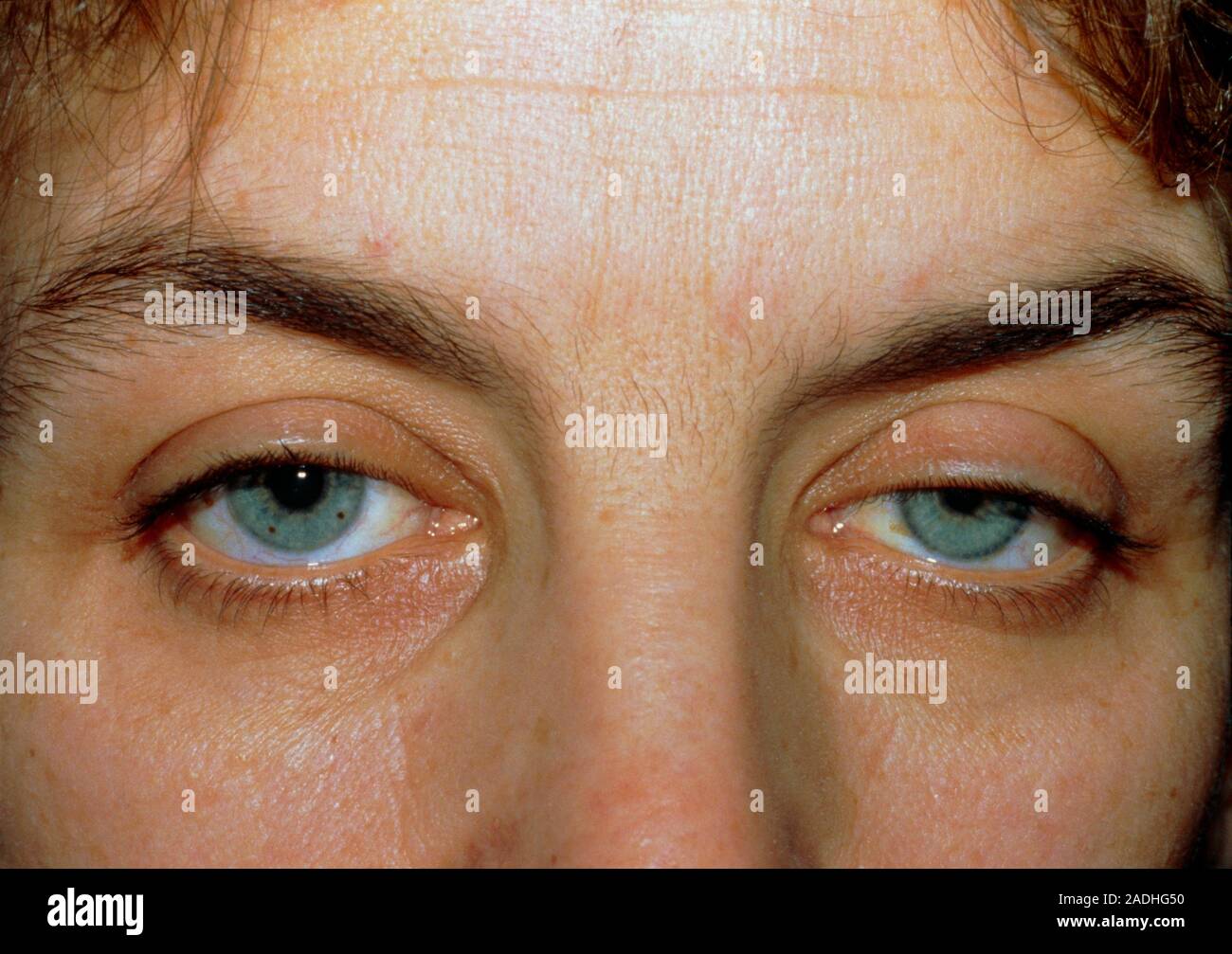 Horner's syndrome in a young man, showing a constricted right pupil ...