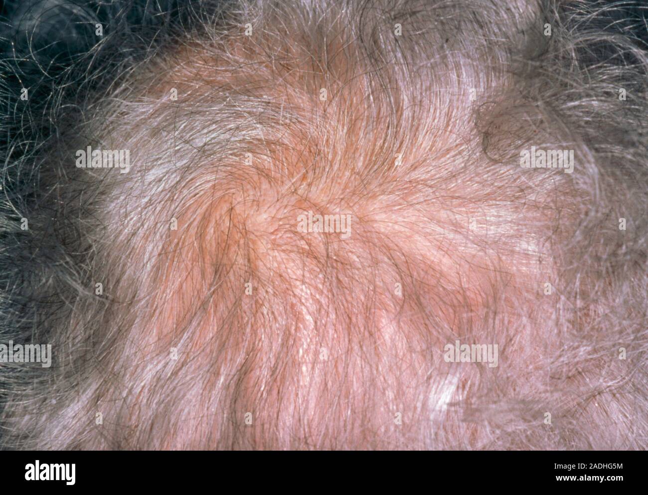 Hypothyroidism. Diffuse hair loss or alopecia due to hypothyroidism ...