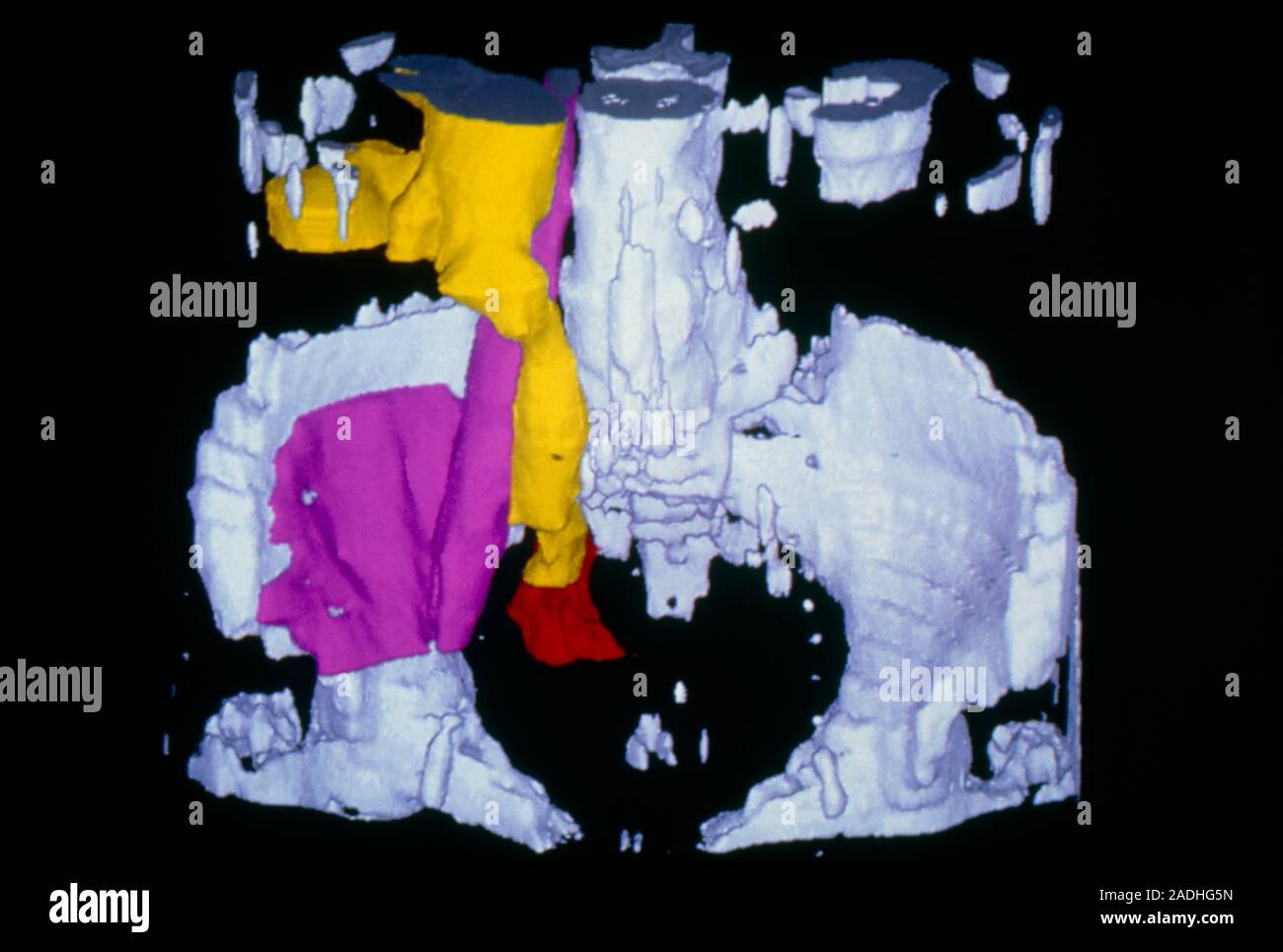 False-colour three-dimensional computed tomography (CT) scan of the ...