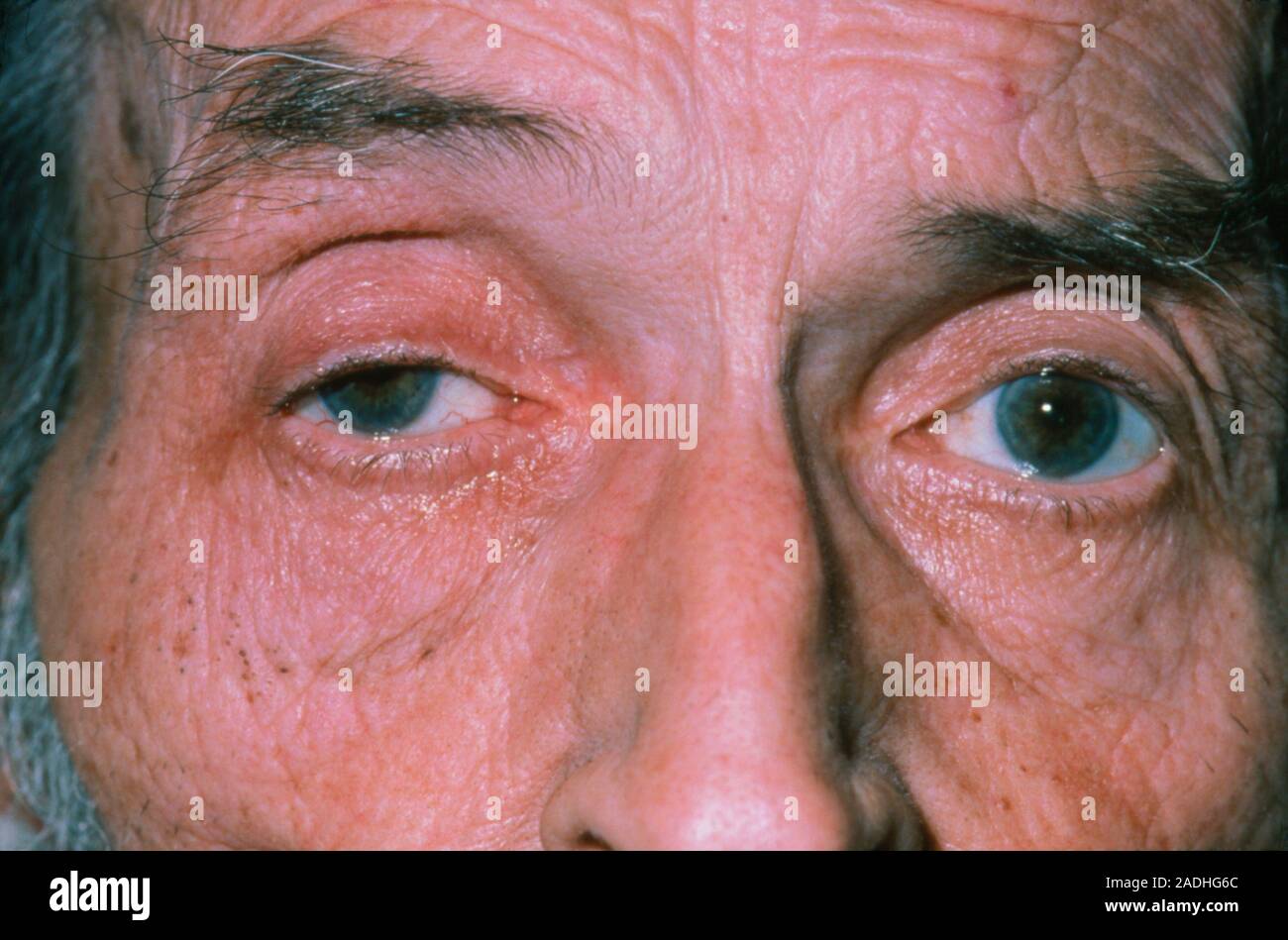 Horner's syndrome. The face of an elderly man showing Horner's syndrome ...