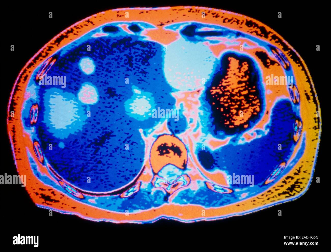 Hydatid disease. Coloured computed tomography (CT) scan showing cysts ...