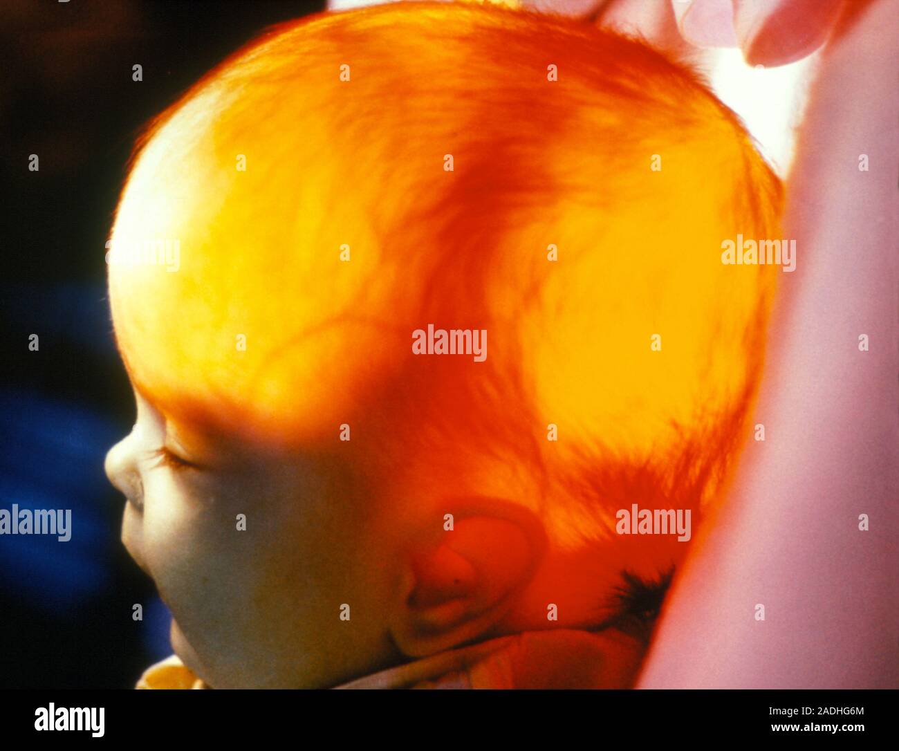 Hydrocephalus. Red transillumination of the head of a baby suffering ...
