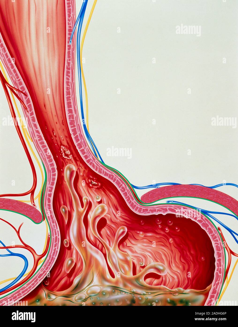 Hiatus hernia. Illustration of a hiatus hernia, showing gastro ...