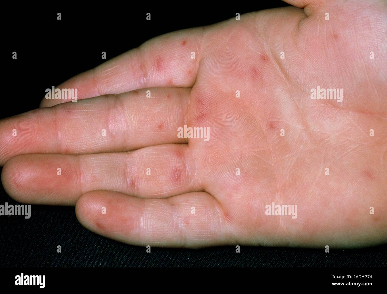 Hand, foot & mouth disease. Skin lesions on the hand of a four year-old ...