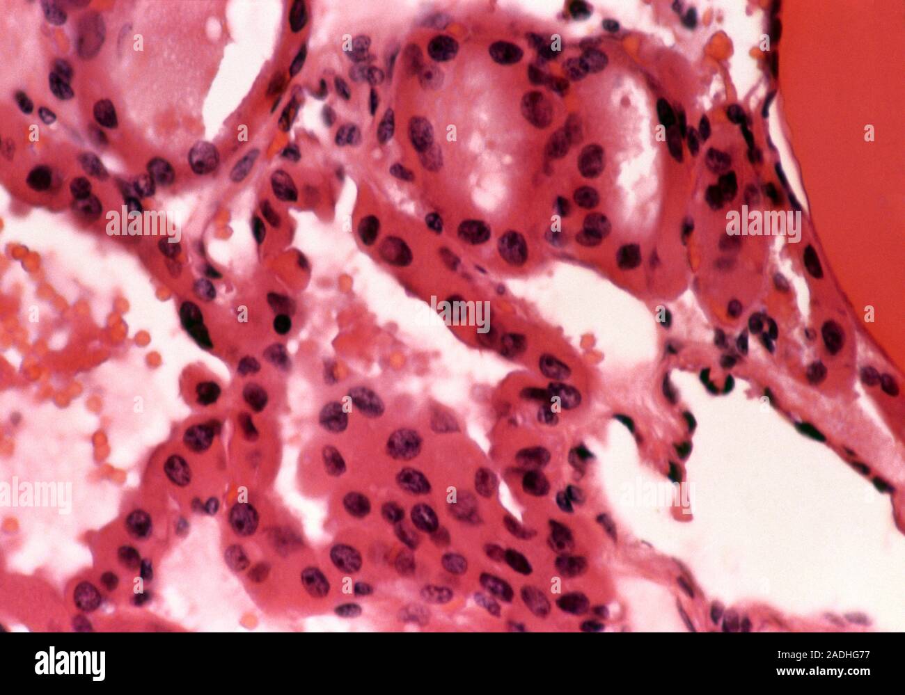 Hurthle cell tumour. Light micrograph cross- section through a Hurthle ...