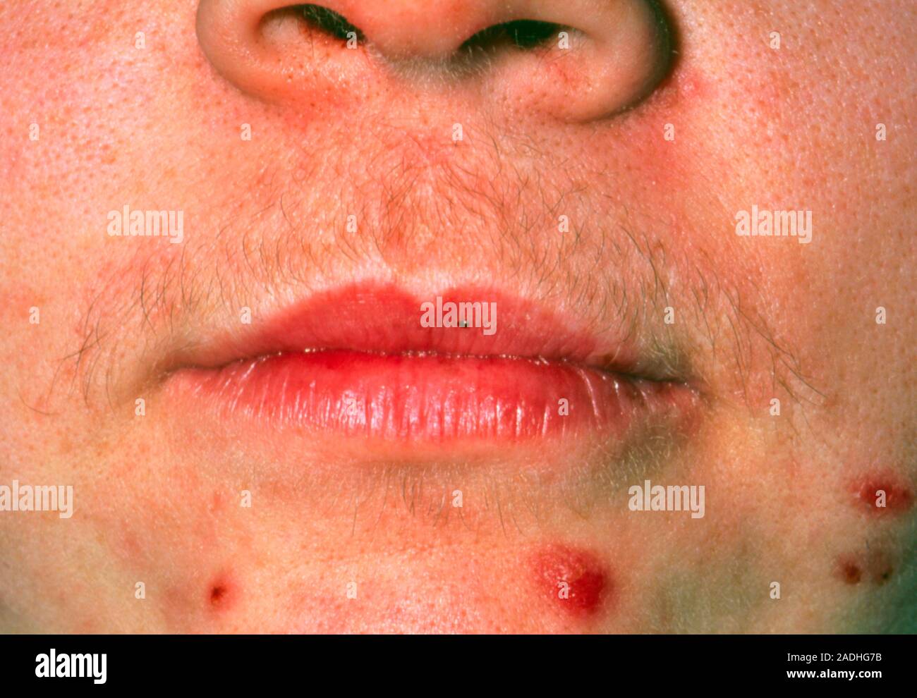 Hirsutism. Hirsutism (excessive hairiness) on the face of a 24-year-old woman. Hirsutism occurs ...
