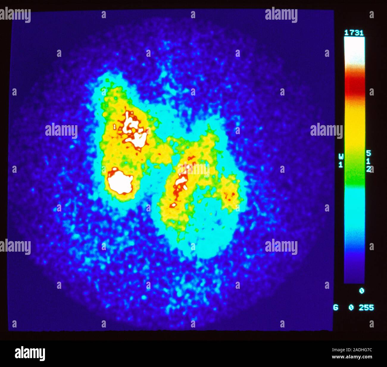Enlarged thyroid. Coloured gamma scan of an enlar- ged thyroid gland ...