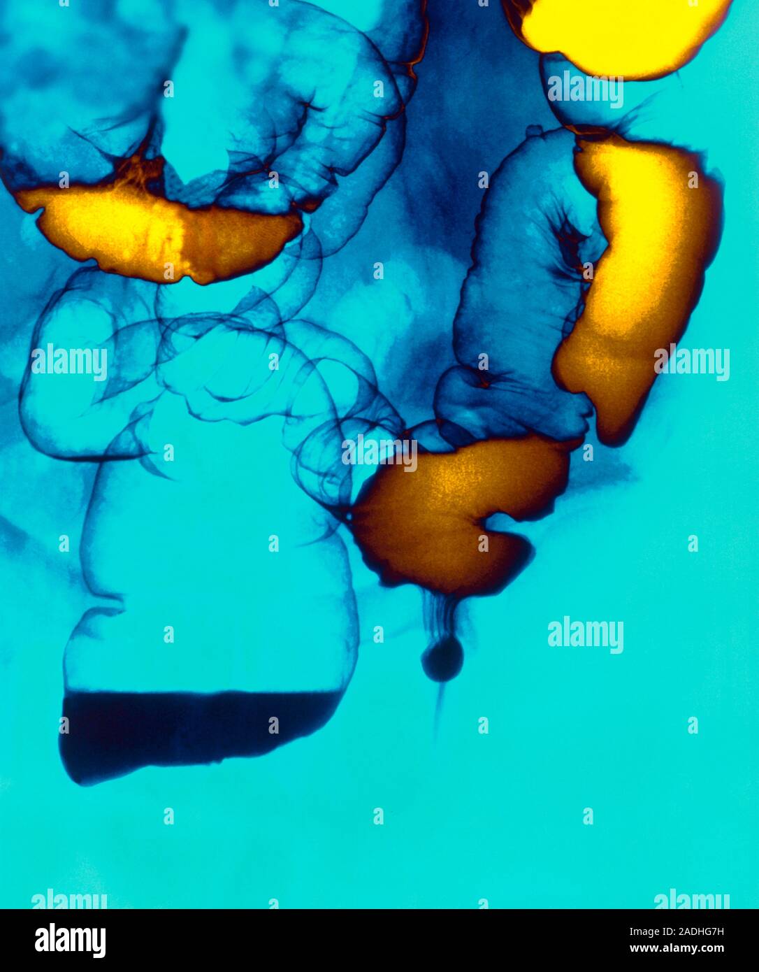 Inguinal hernia. Coloured barium X-ray of a left inguinal (groin ...