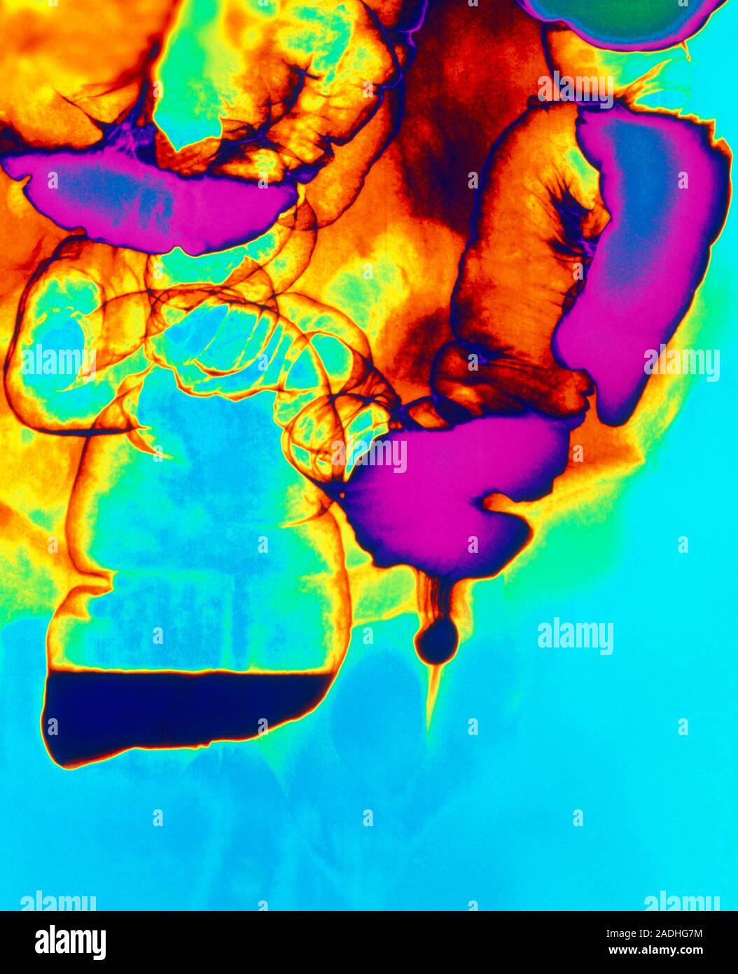 Inguinal hernia. Coloured barium X-ray of a left inguinal (groin ...