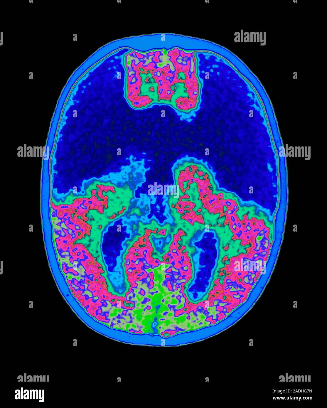 Holoprosencephaly. Coloured magnetic resonance imaging (MRI) scan of a brain (pink/green) with ...