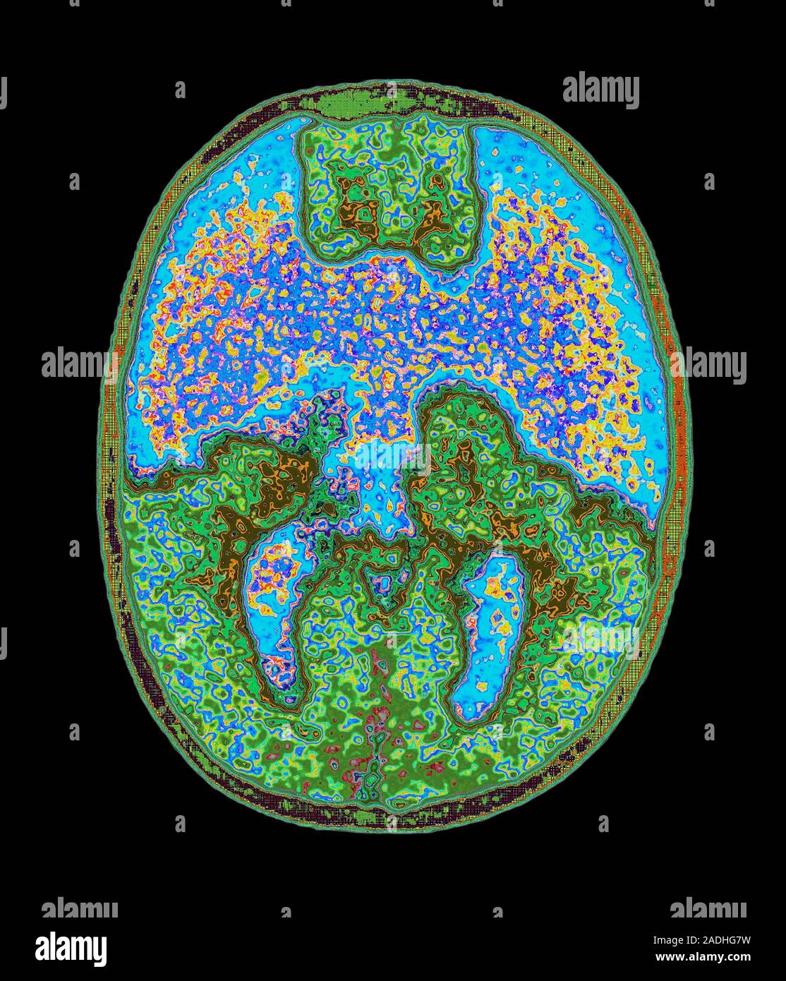 Holoprosencephaly. Coloured magnetic resonance imaging (MRI) scan of a brain (green) with ...