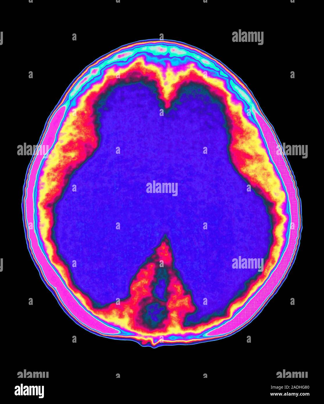Hydrocephalus. Coloured computed tomography (CT) scan of an axial ...
