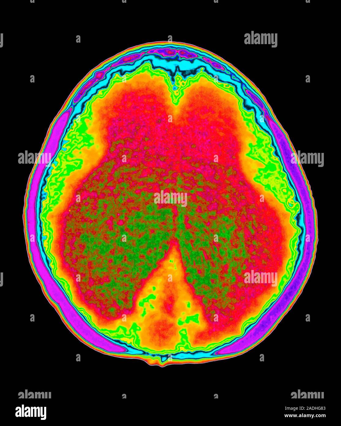 Hydrocephalus. Coloured computed tomography (CT) scan of an axial ...