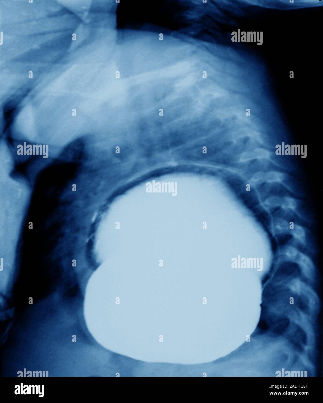 Hiatus hernia. Barium X-ray of the stomach of a 9- month-old child ...