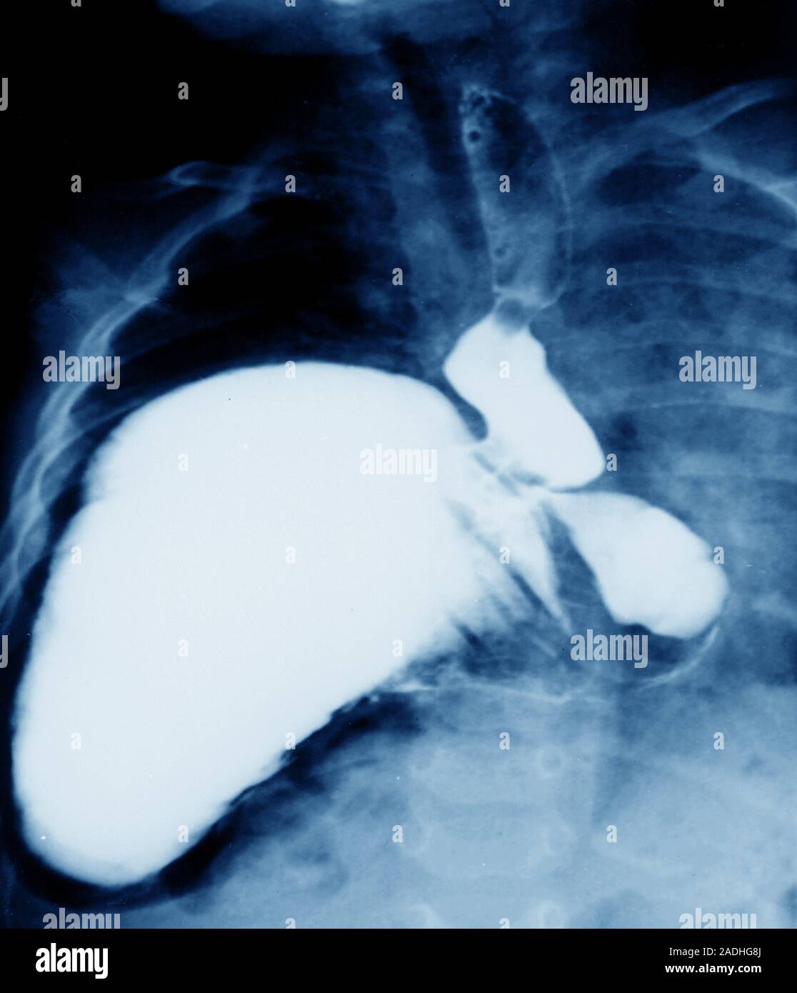 Hiatus hernia. Barium X-ray of the stomach (white) of a 9-month-old ...