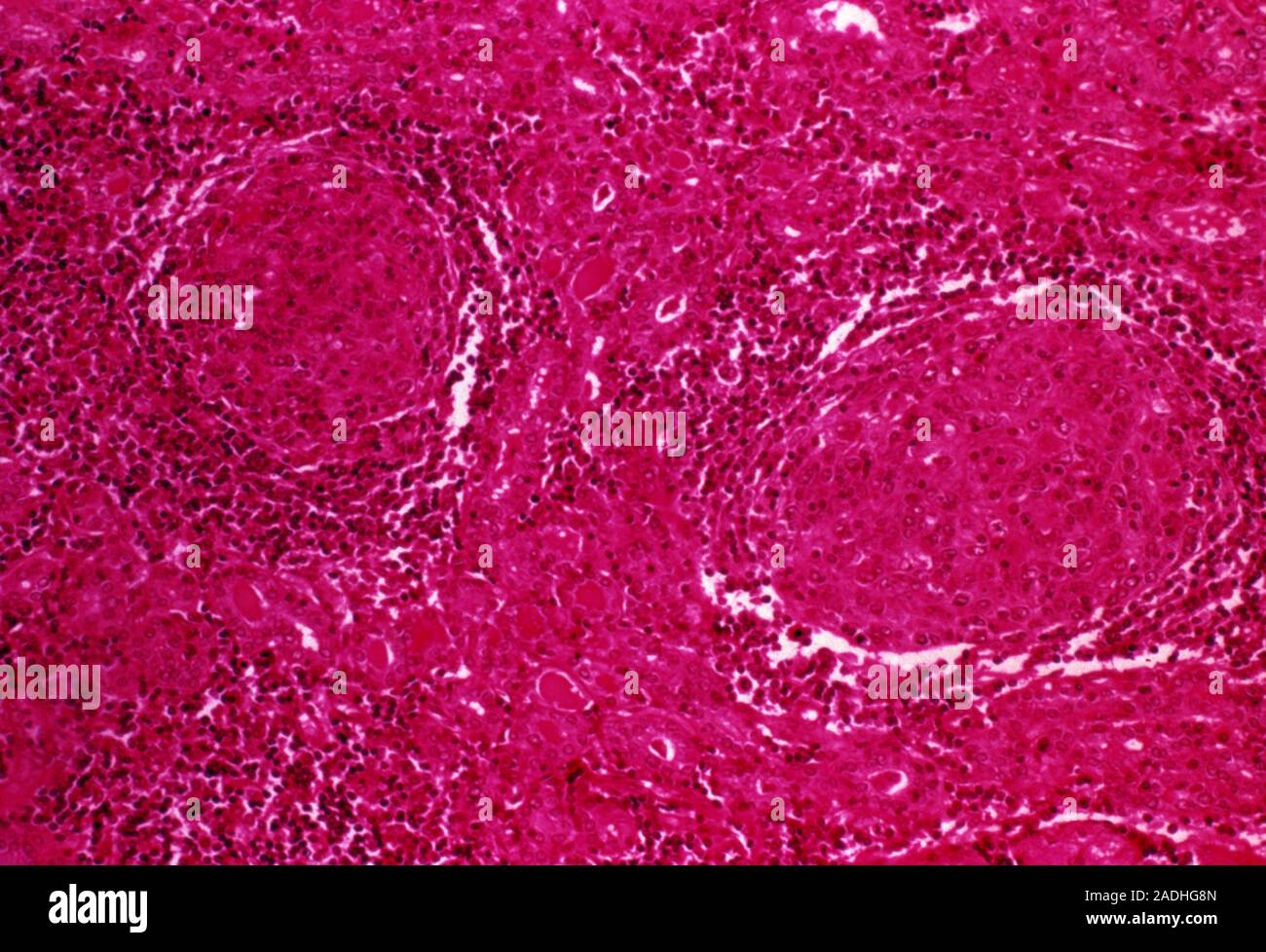 Thyroid disease. Light micrograph of a section through a thyroid gland ...