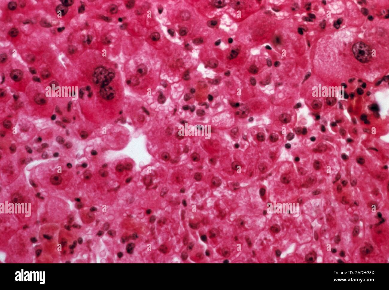 Viral hepatitis. Light micrograph of a section through a human liver ...