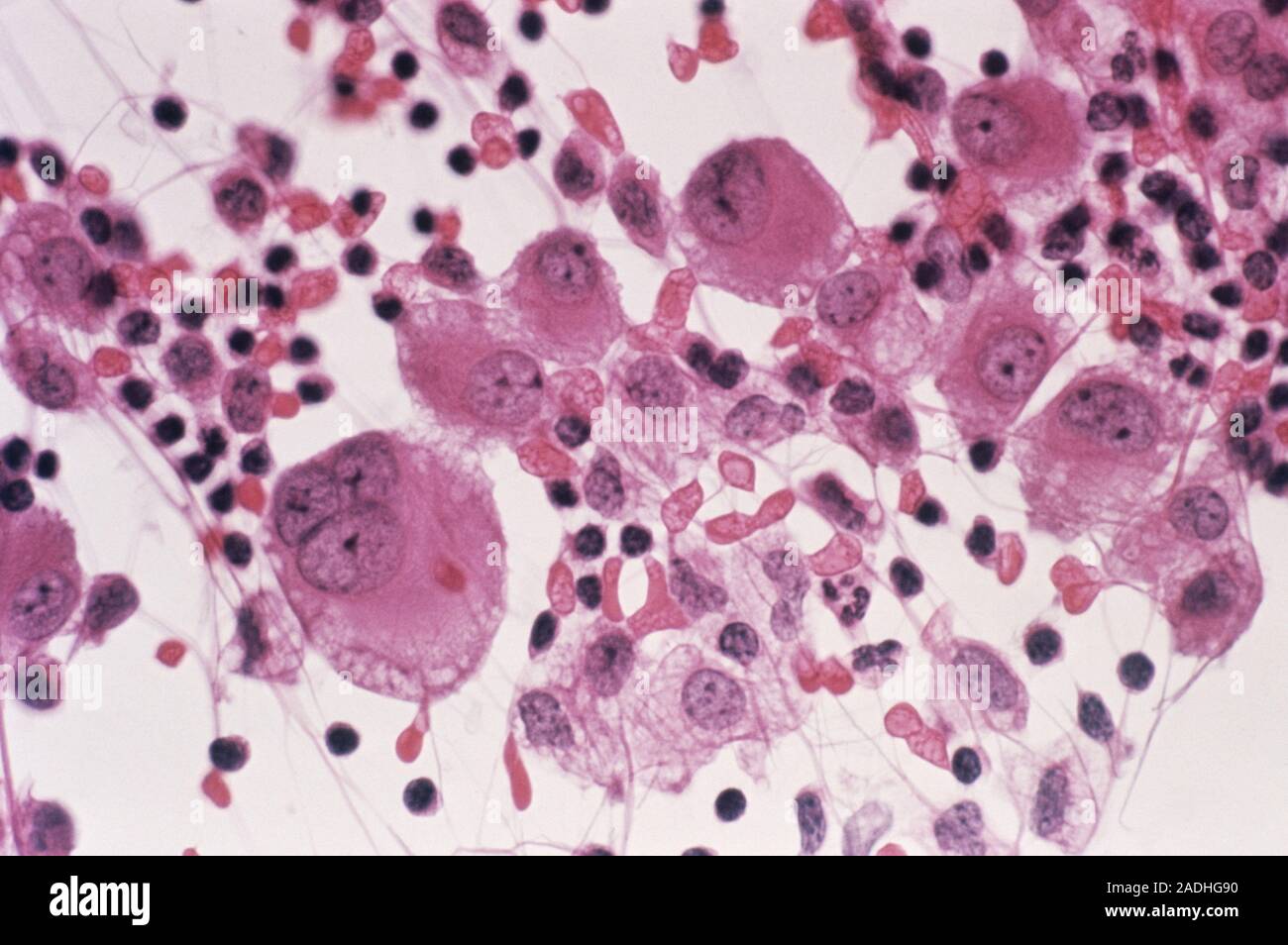 Lung tissue hyperplasia. Light micrograph of a section through lung ...
