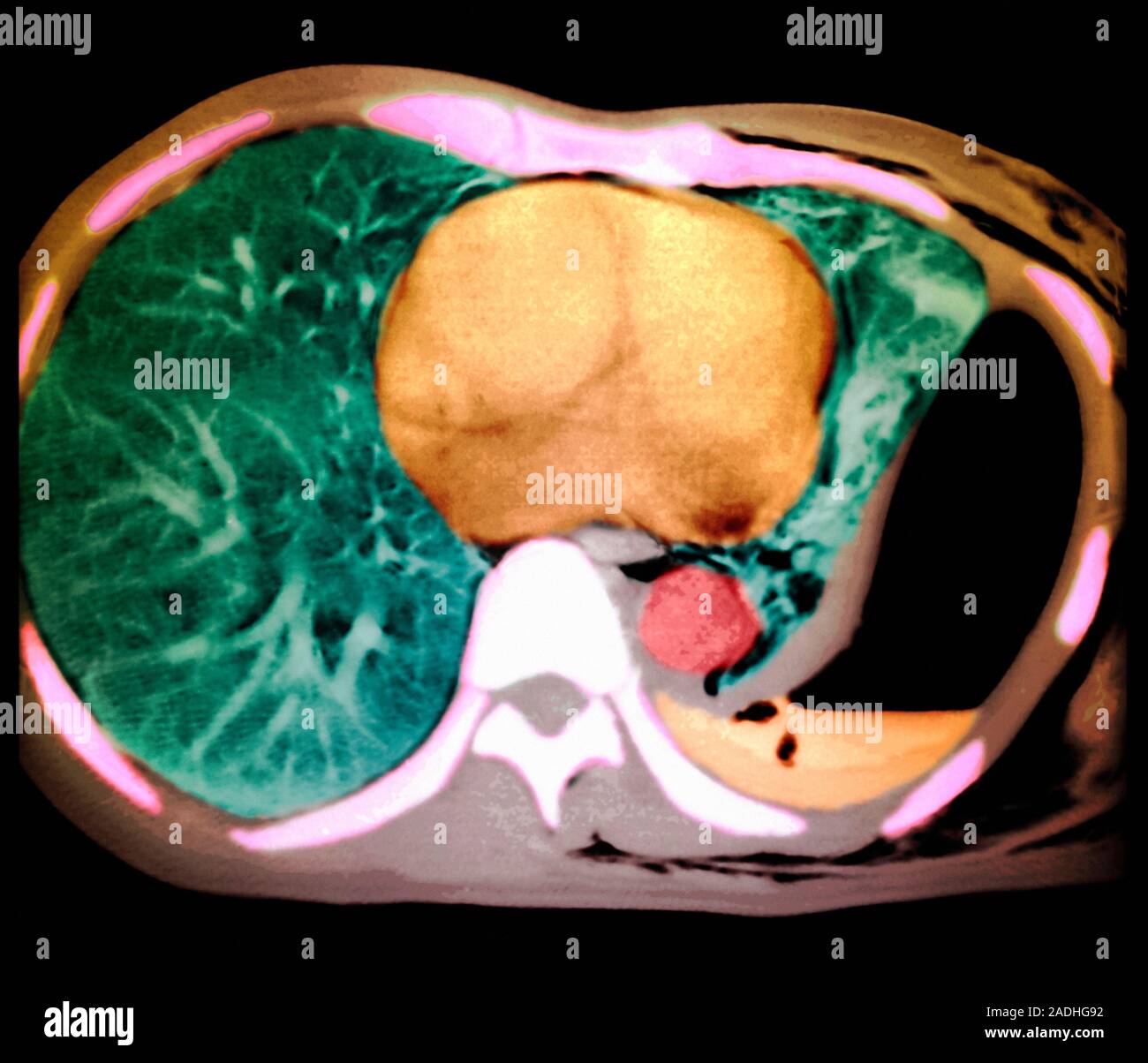 Collapsed lung. Coloured computed tomography (CT) scan through a ...
