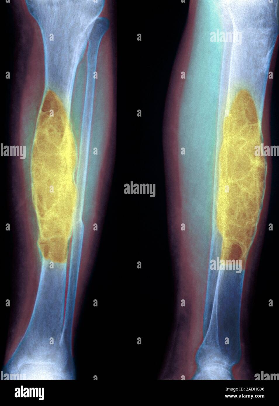 Brown tumours. Coloured X-ray of brown tumours (yellow) along the ...