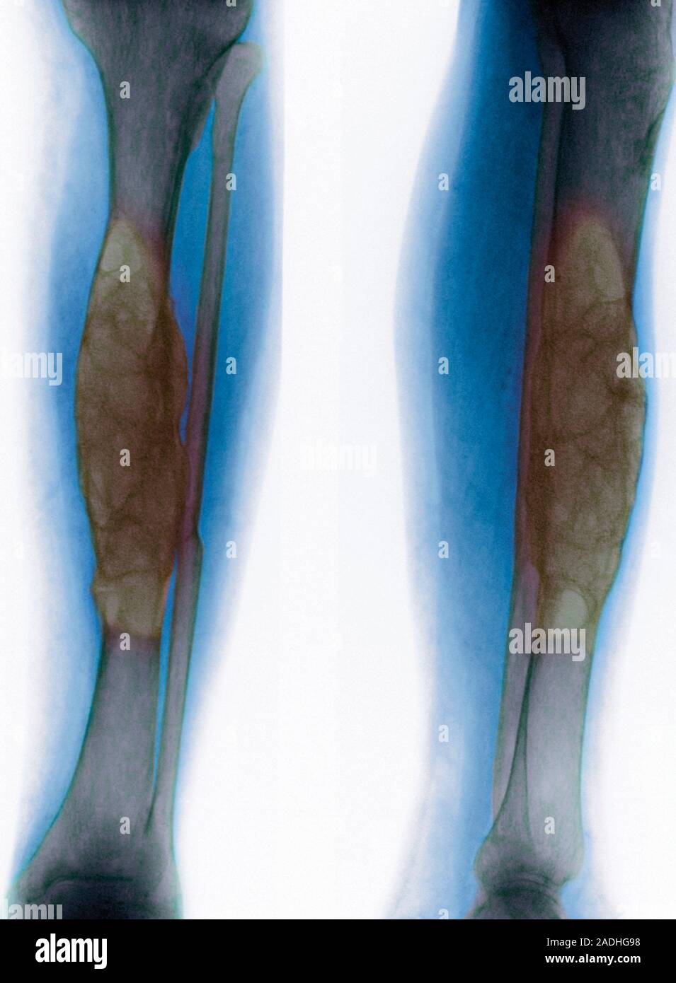 Brown tumours. Coloured X-ray of brown tumours (brown) along the shafts ...
