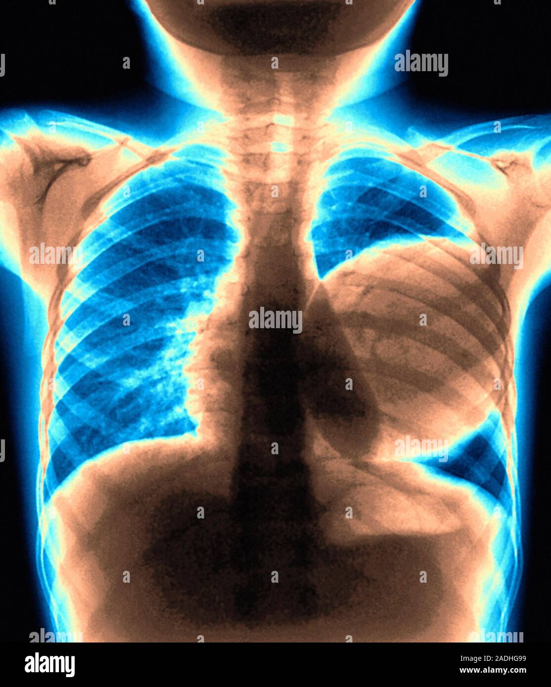 Cyst in a lung. Coloured X-ray of the chest of a seven year old child ...
