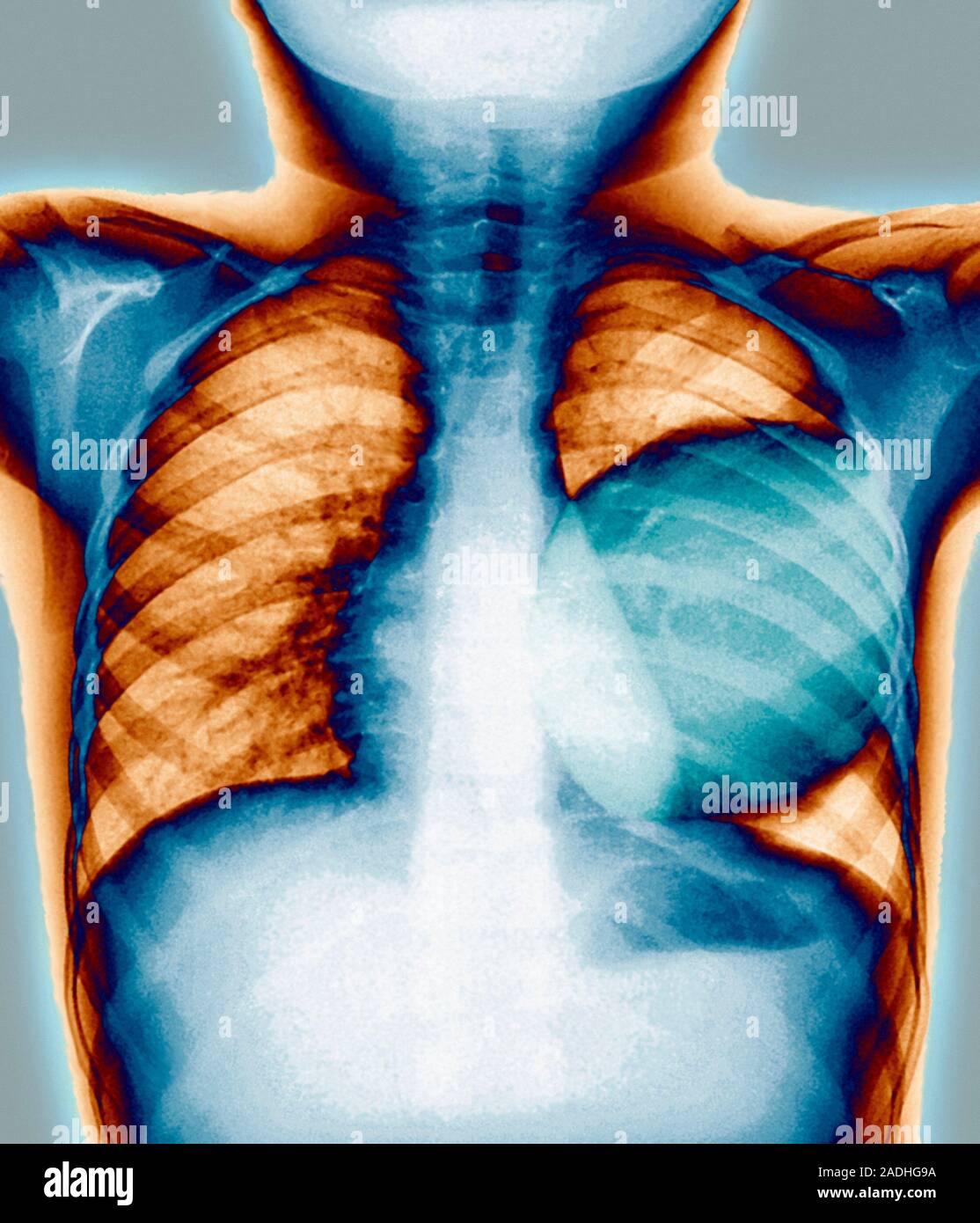 Cyst in a lung. Coloured X-ray of the chest of a seven year old child ...
