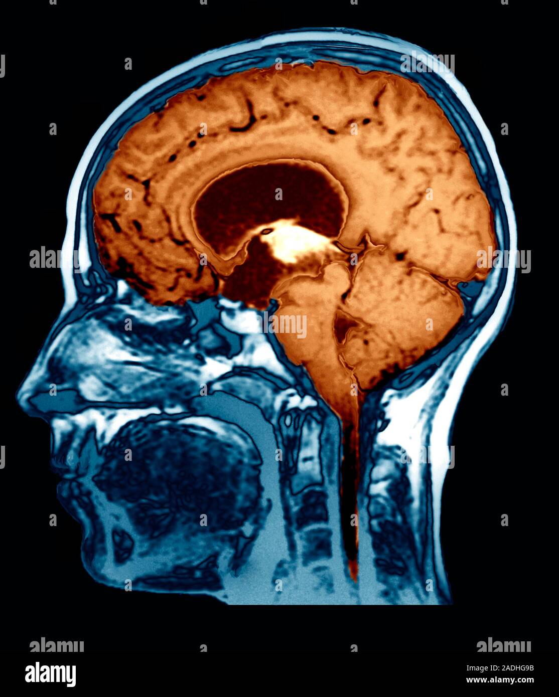 Water on the brain. Coloured magnetic resonance imaging (MRI) scan of a ...