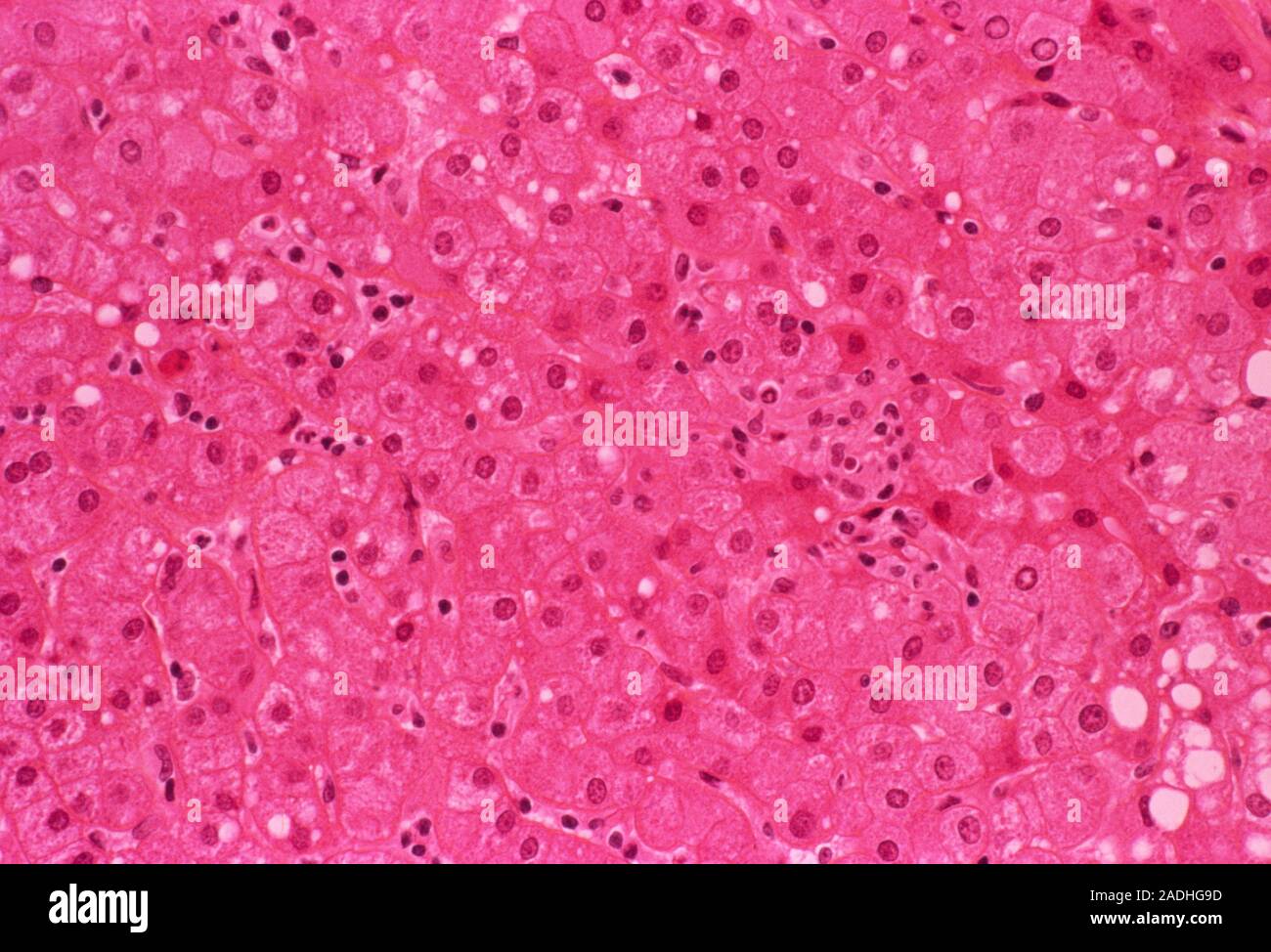 Viral hepatitis. Light micrograph of a section through liver tissue in ...