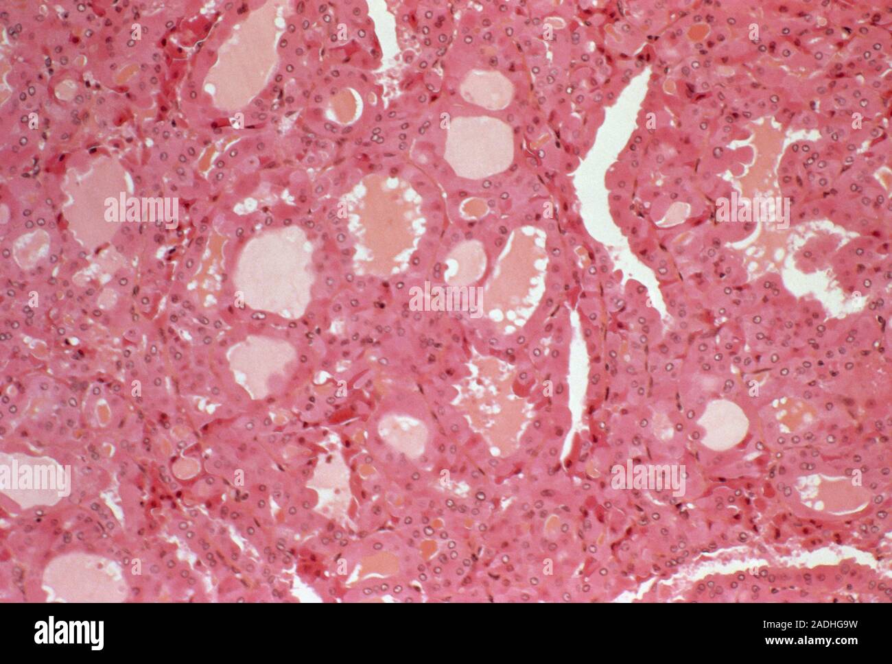 Thyroid tumour. Light micrograph of a section through tissue from a ...