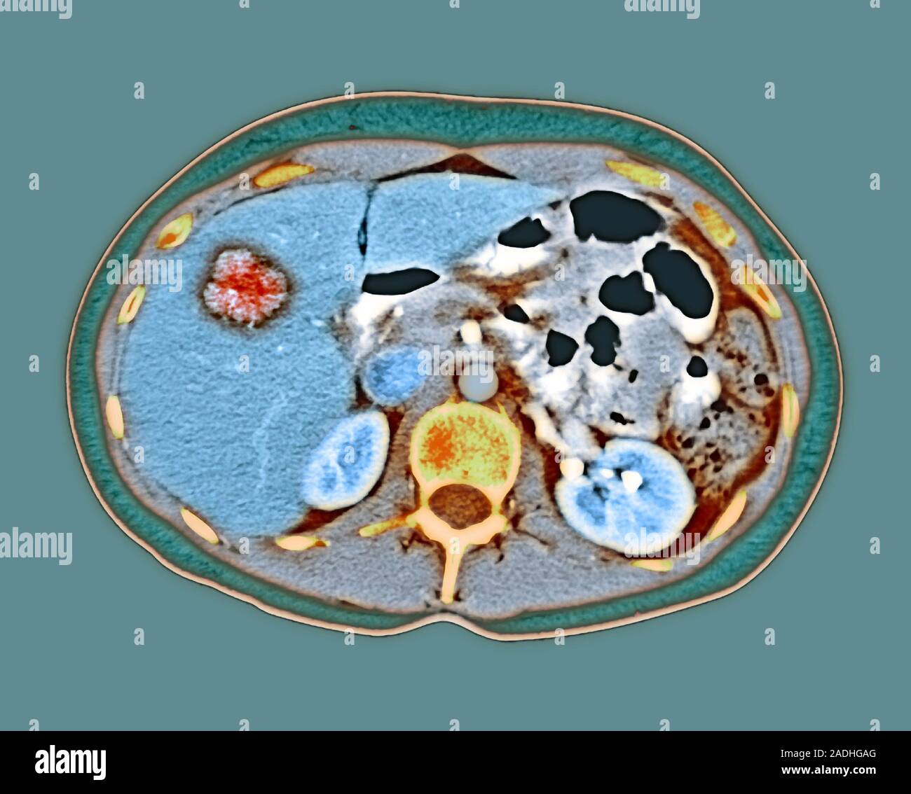 Benign liver tumour. Coloured computed tomography (CT) scan of the ... Benign liver tumour. Coloured computed tomography (CT) scan of the ...