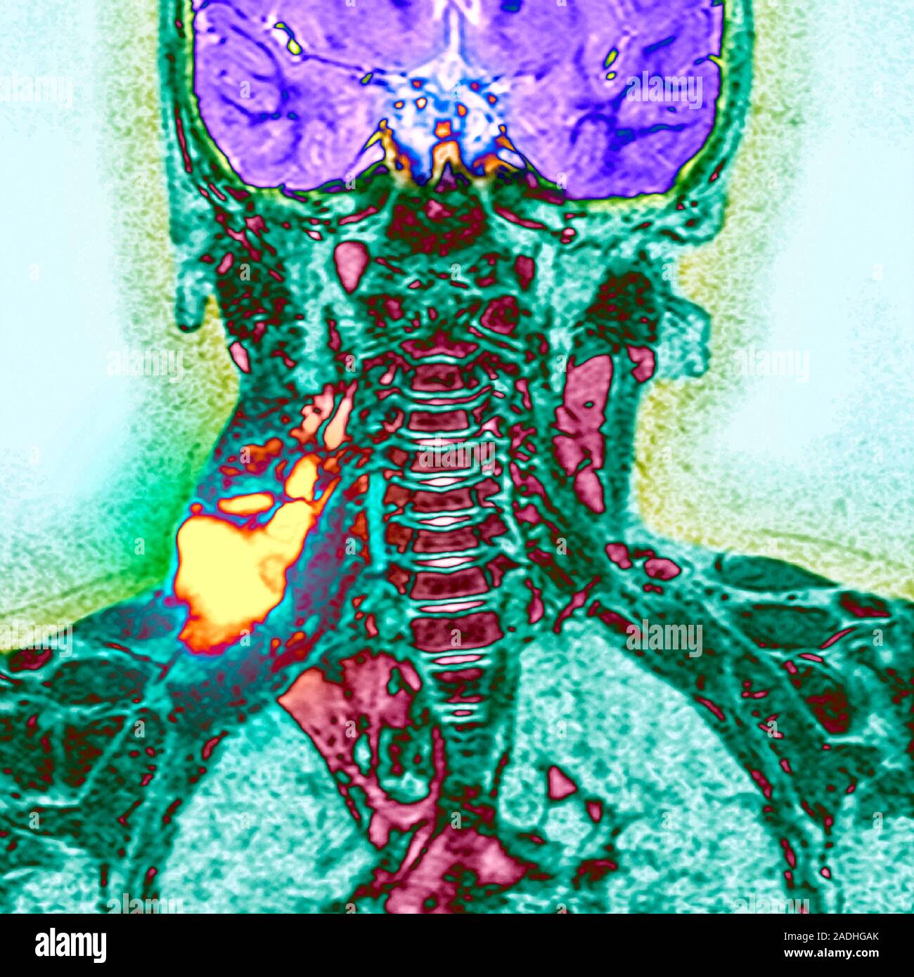 Cystic hygroma. Coloured magnetic resonance imaging (MRI) scan of a ...