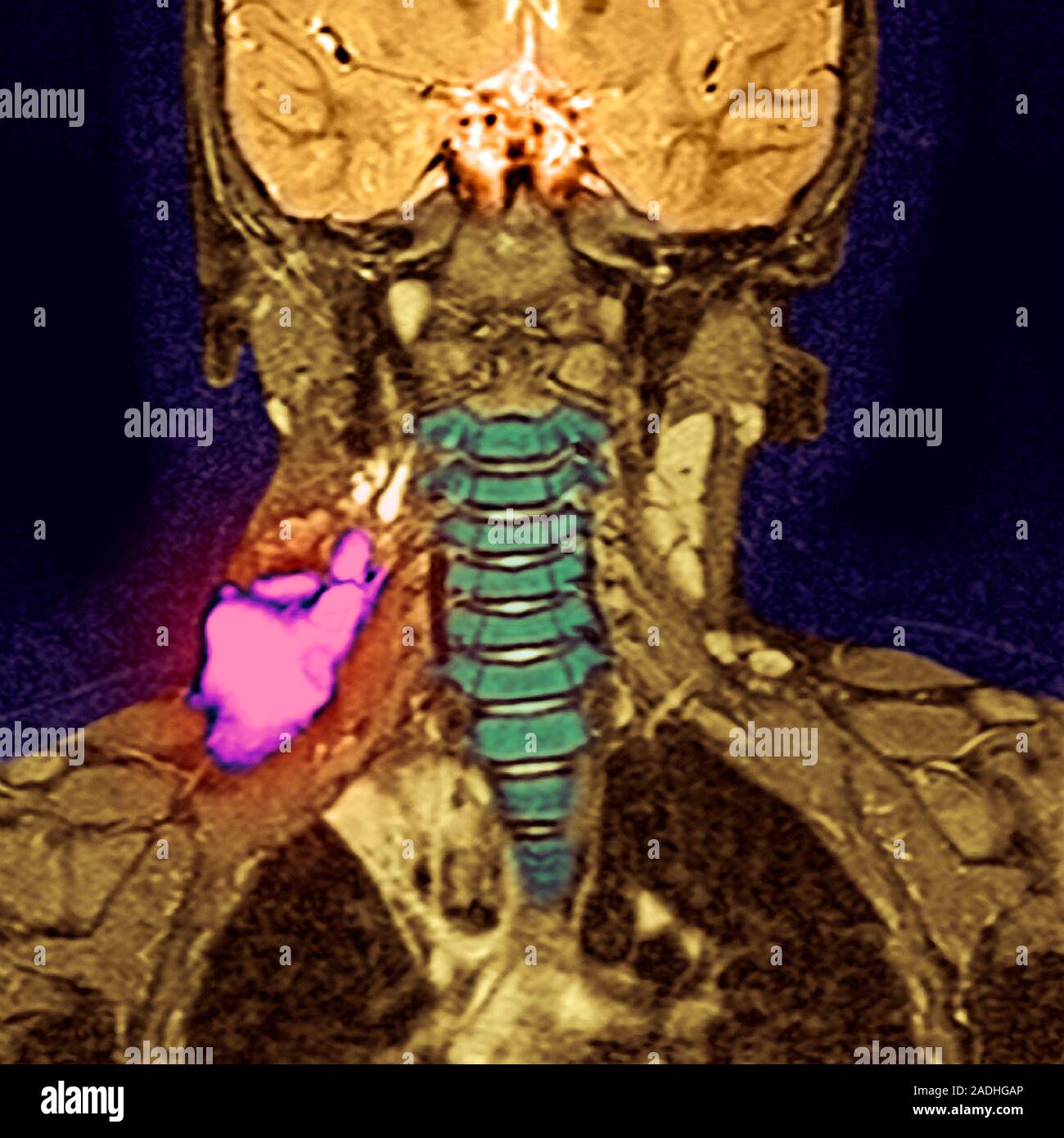 Cystic hygroma. Coloured magnetic resonance imaging (MRI) scan of a ...