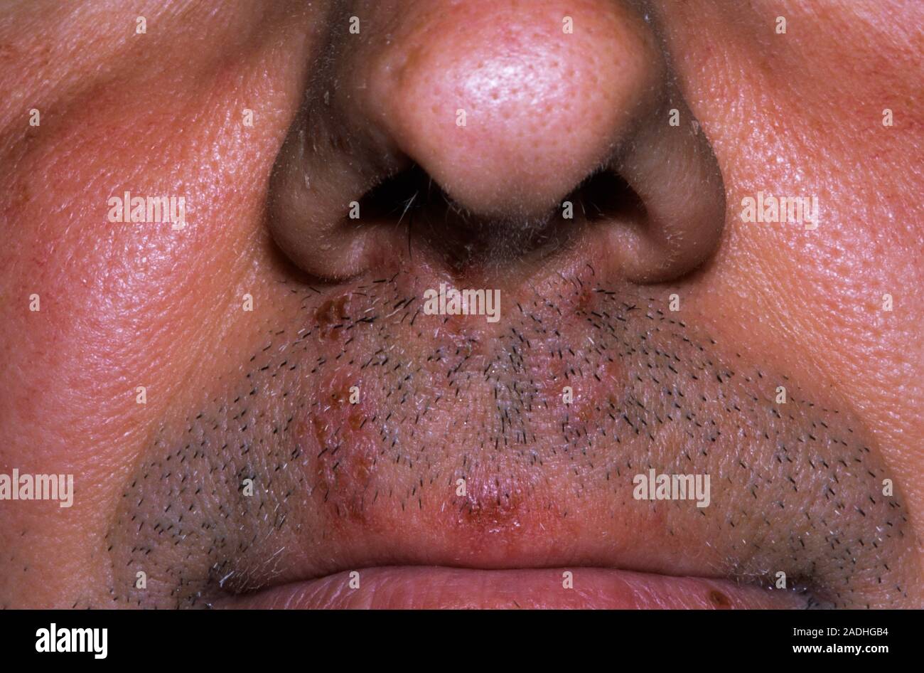 Cold sores around a man's mouth caused by the Herpes simplex virus (HSV ...