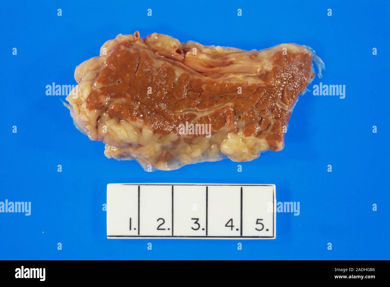 Damaged pancreas. Gross specimen of a pancreas damaged by ...
