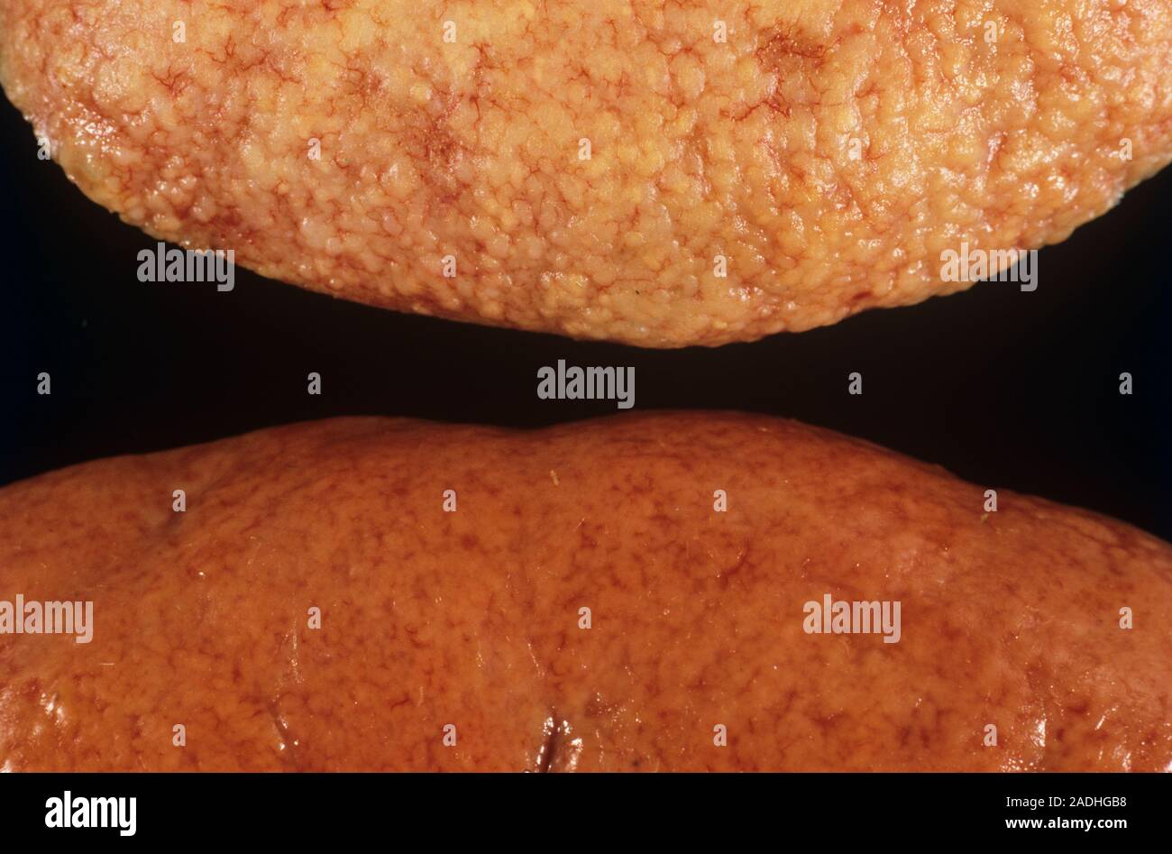 Hypertensive kidney. Gross specimens of a normal healthy kidney (bottom ...