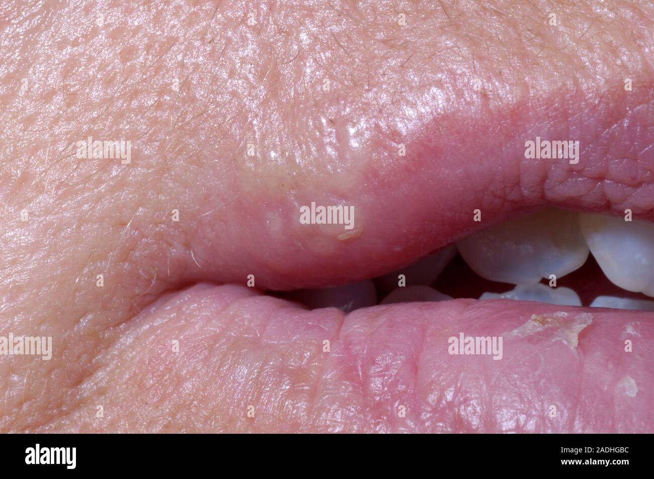 Early Herpes On Lips