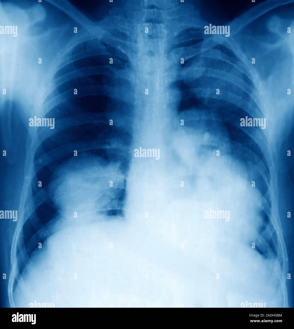 Pulmonary tapeworm cysts. Coloured chest X-ray showing hydatid cysts ...