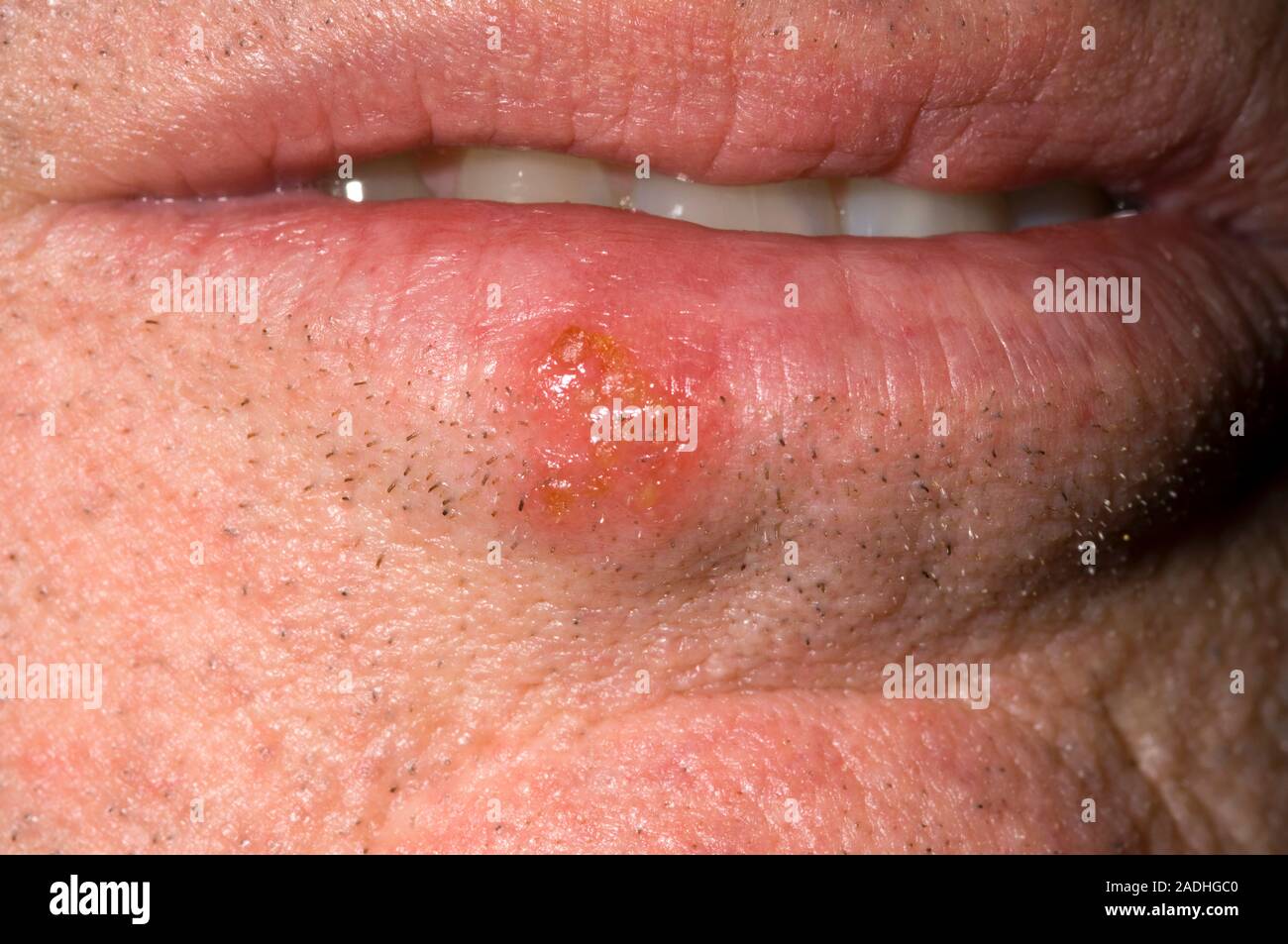 Cold Sore Lesion Orange On The Lower Lip Of A 50 Year Old Man Cold Sores Are Caused By The