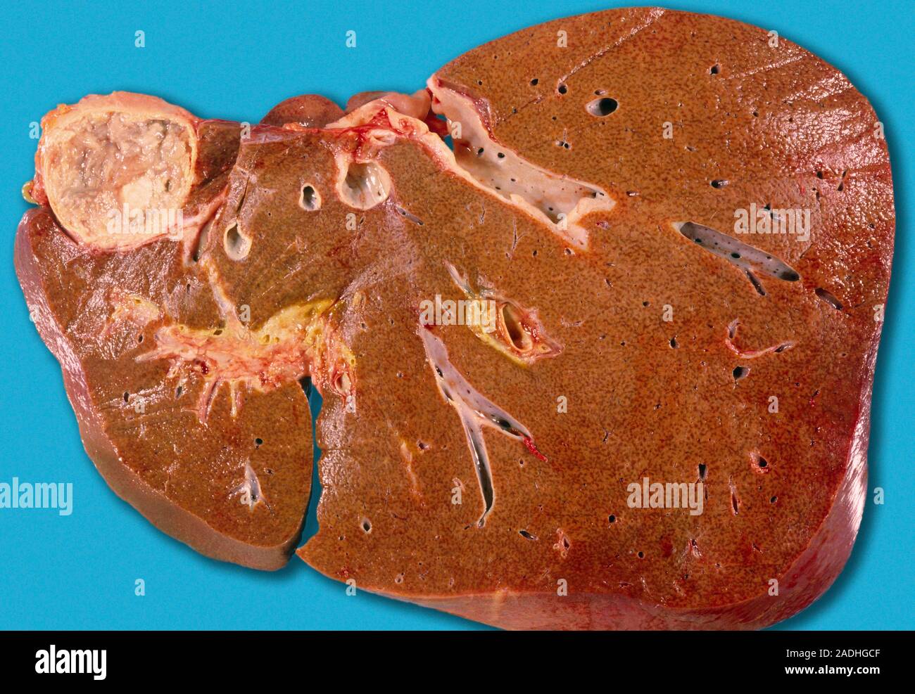 Hydatid Cyst In Liver Gross Specimen Of A Cyst In A Patients Liver Arising From Infestation
