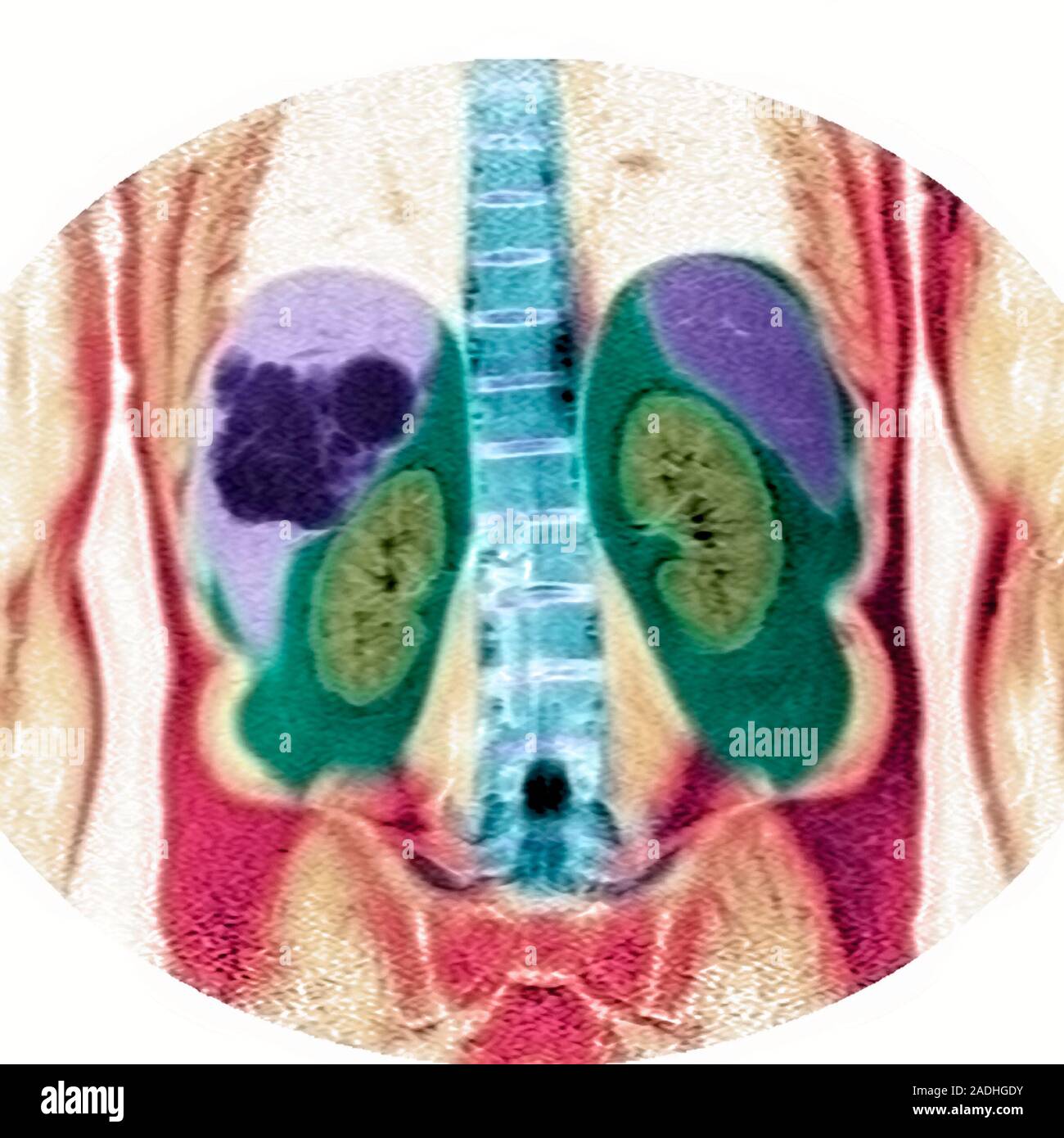 Liver blood vessel tumour. Coloured magnetic resonance imaging (MRI ...