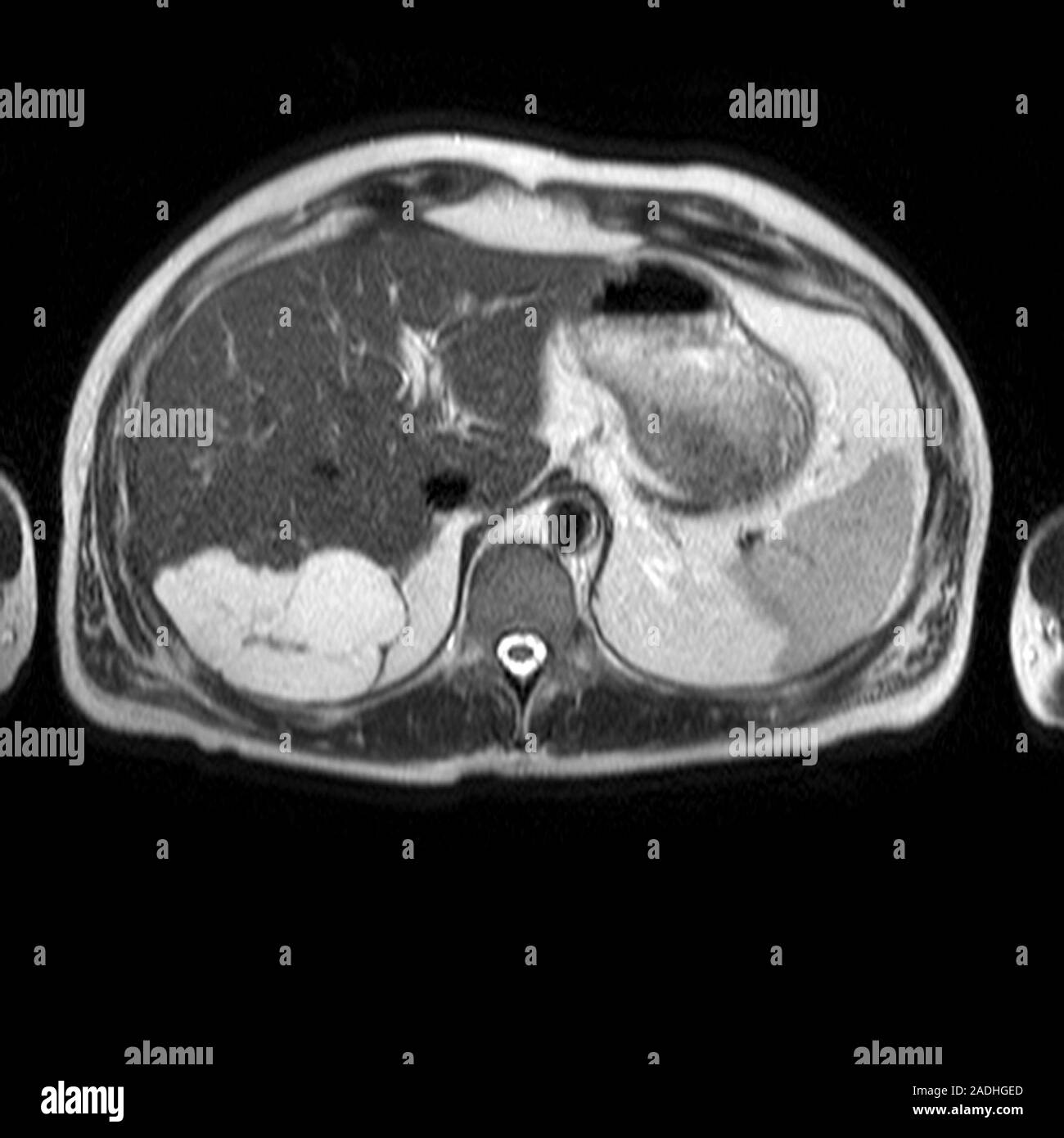 Liver blood vessel tumour. Magnetic resonance imaging (MRI) scan of an ...
