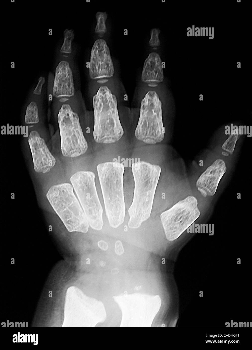 Hurler syndrome. X-ray of the hand of a 28 month old child with Hurler syndrome (also called ...